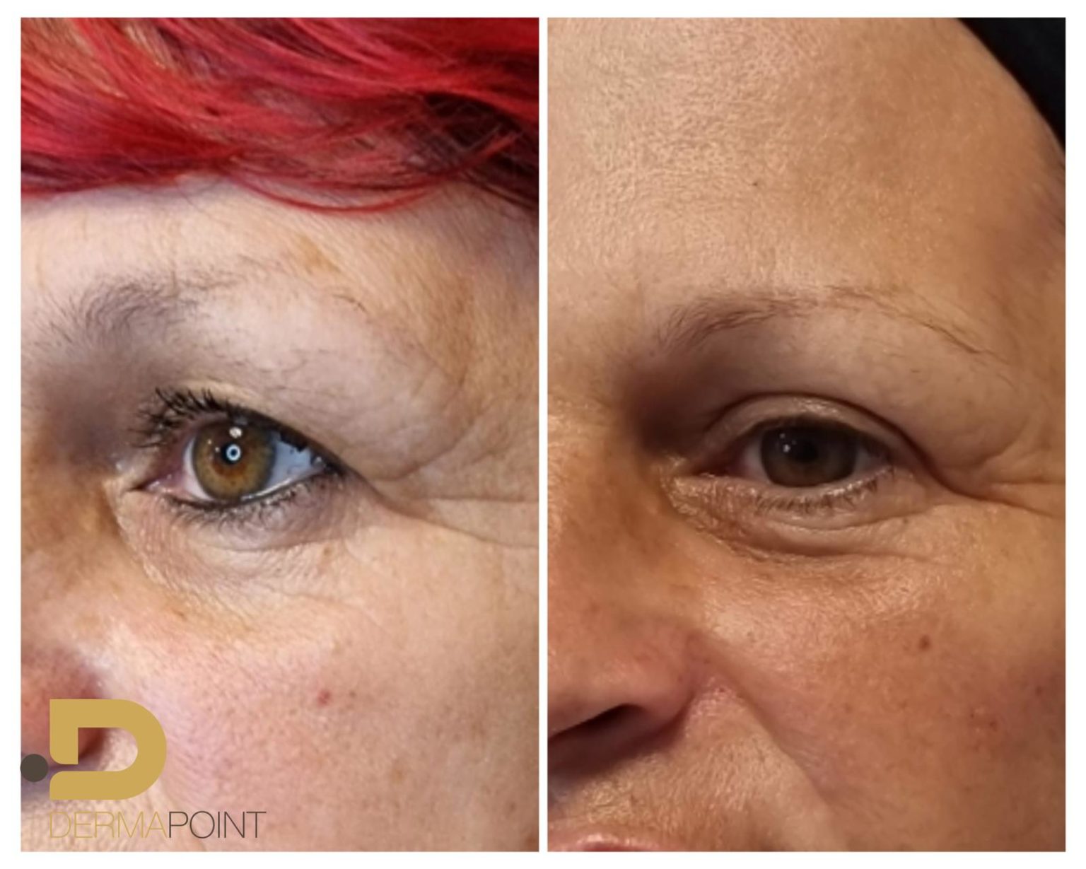 Blefaroplastika ako lifting horných viečok u nás na klinike | Dermapoint